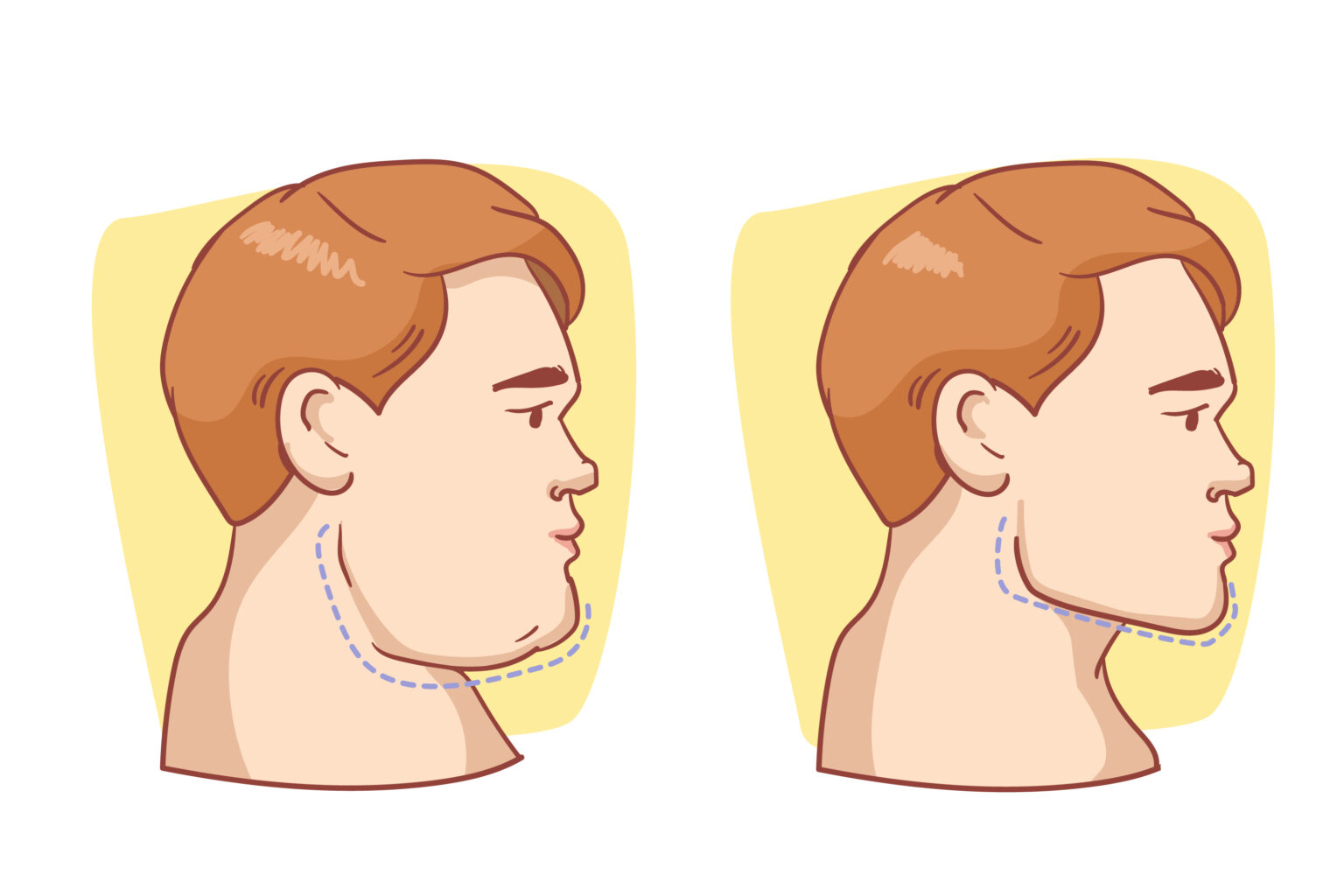 Can Neck Exercises Reduce Double Chin? Get Rid Of Fat And Sculpt Your ...